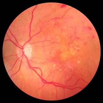 Inherited Retinal Diseases Overview, Patient Resources, and Clinical ...