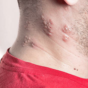 Implementing a Shingles Protocol in Specialty Practices - CME ...